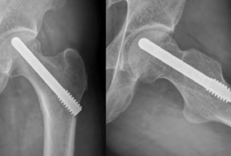 HIP- AVASCULAR NECROSIS/OSTEONECROSIS - Treatment