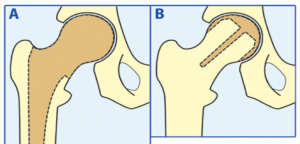 Hip Resurfacing Treatment Melbourne | Dr David Slattery