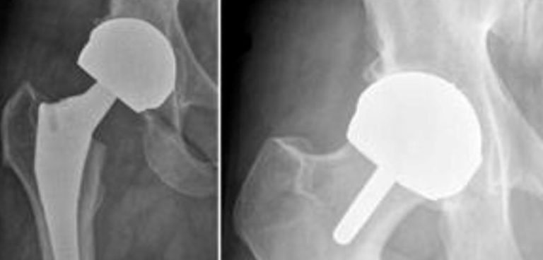 Hip Resurfacing Treatment Melbourne | Dr David Slattery