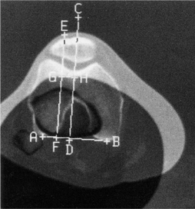 Causes of Patellar Dislocation & Instability (Unstable Kneecap)