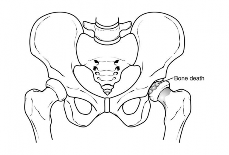 PERTHES DISEASE (LEGG-CALVE-PERTHES DISEASE) - Description