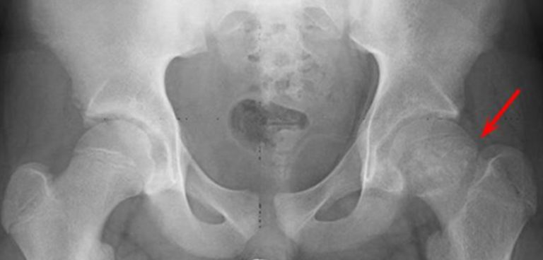SCFE/SUFE - Slipped Capital Femoral Epiphysis - Treatment