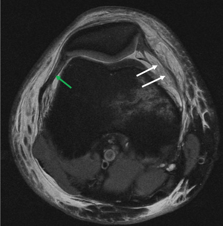 Patella Stabilisation Treatment | David Slattery