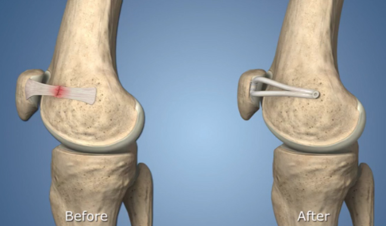 Patella Stabilisation Treatment | David Slattery