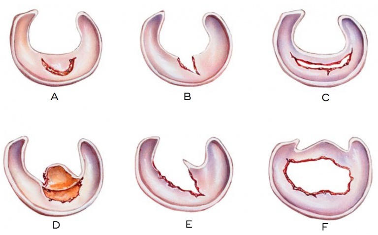 Causes of Degenerative Meniscal Tears | David Slattery