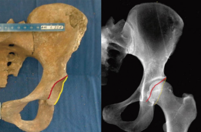 What is Acetabular Retroversion? | David Slattery