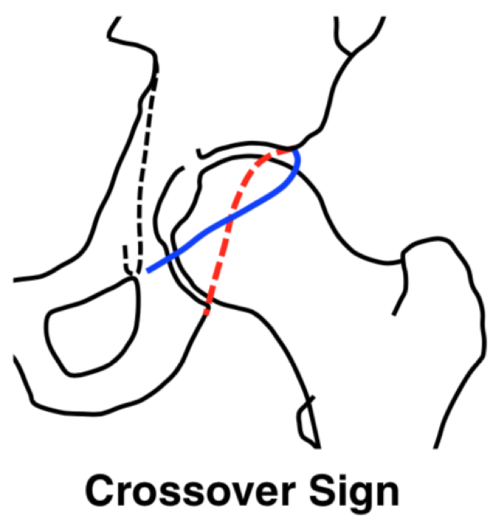 Acetabular Retroversion | David Slattery Orthopaedic Surgeon
