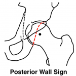 Acetabular Retroversion | David Slattery Orthopaedic Surgeon