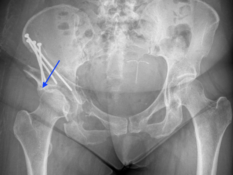 Periacetabular Osteotomy (PAO) | David Slattery